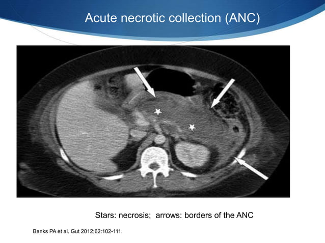 Endoscopic management of walled of pancreatic necrosis | PPTX ...
