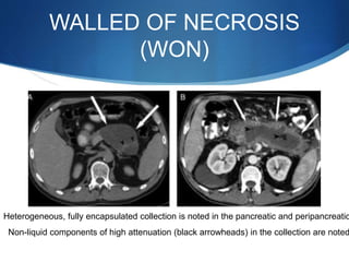 Endoscopic management of walled of pancreatic necrosis | PPTX