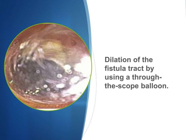 Endoscopic management of walled of pancreatic necrosis | PPTX ...