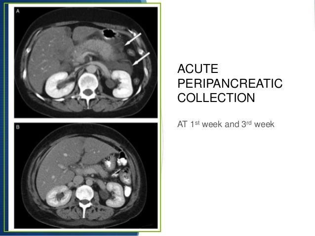 Endoscopic management of walled of pancreatic necrosis