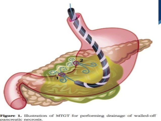 Endoscopic management of walled of pancreatic necrosis