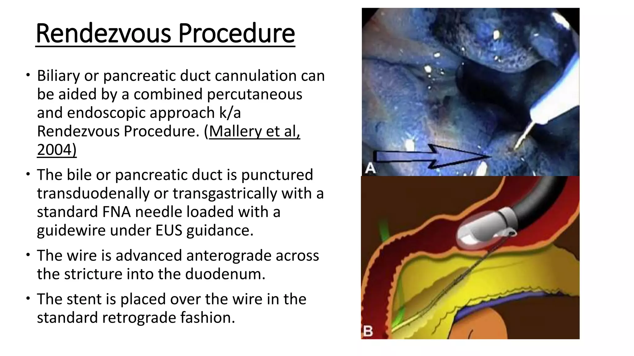 Endoscopic management in pancreatic diseases | PPTX