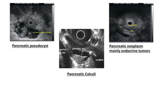 Endoscopic management in pancreatic diseases | PPTX
