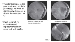 Endoscopic management in pancreatic diseases | PPTX