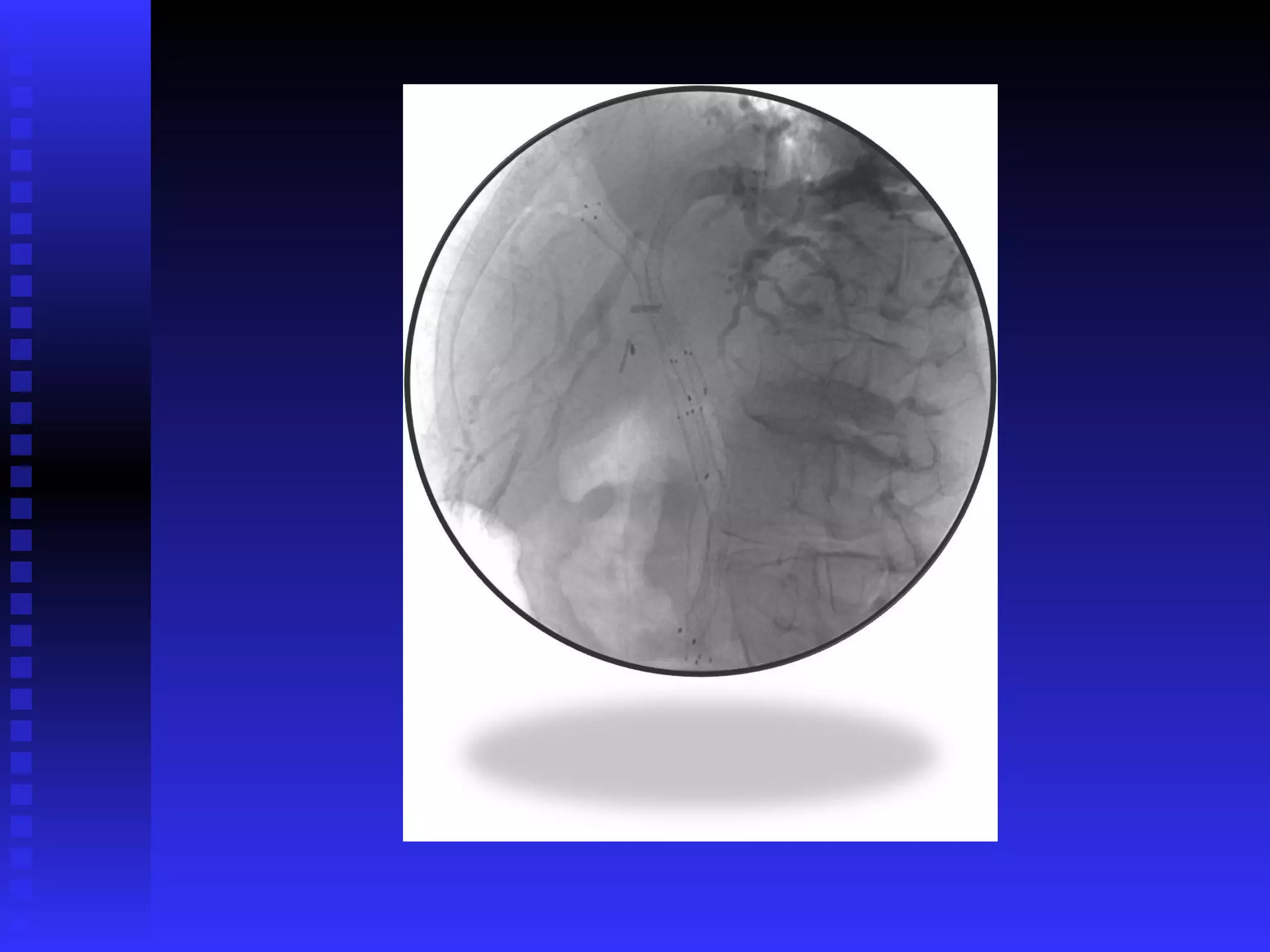 Endoscopic management of bile duct cancers | PPT