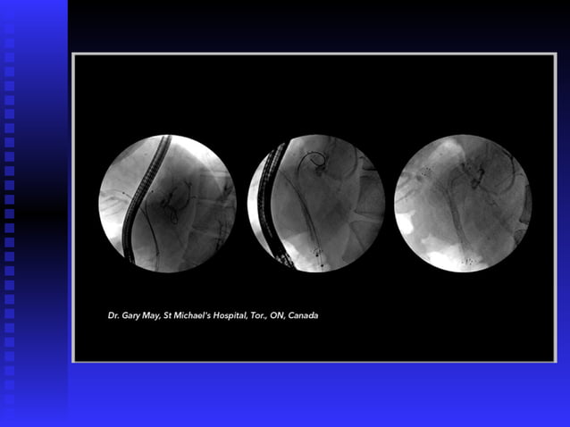 Endoscopic management of bile duct cancers | PPT