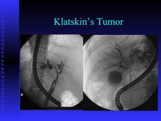 Endoscopic management of bile duct cancers | PPT