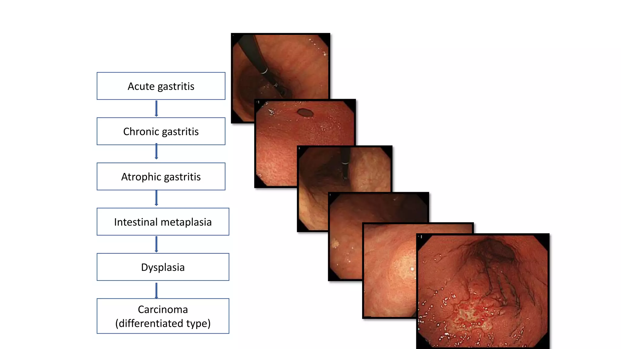 Endoscopic management of early gastric cancer | PPTX