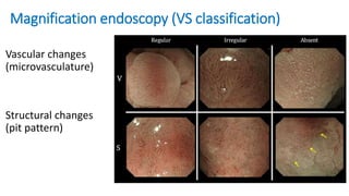 Endoscopic management of early gastric cancer | PPT