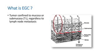 Endoscopic management of early gastric cancer | PPT