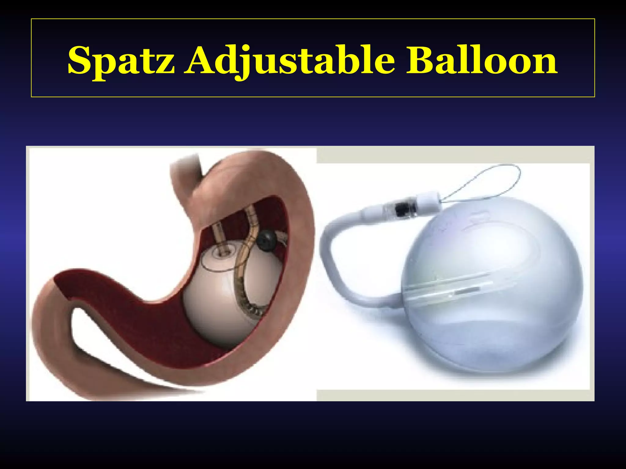 Endoscopic Management Of Obesity-Endobariatrics | PPT