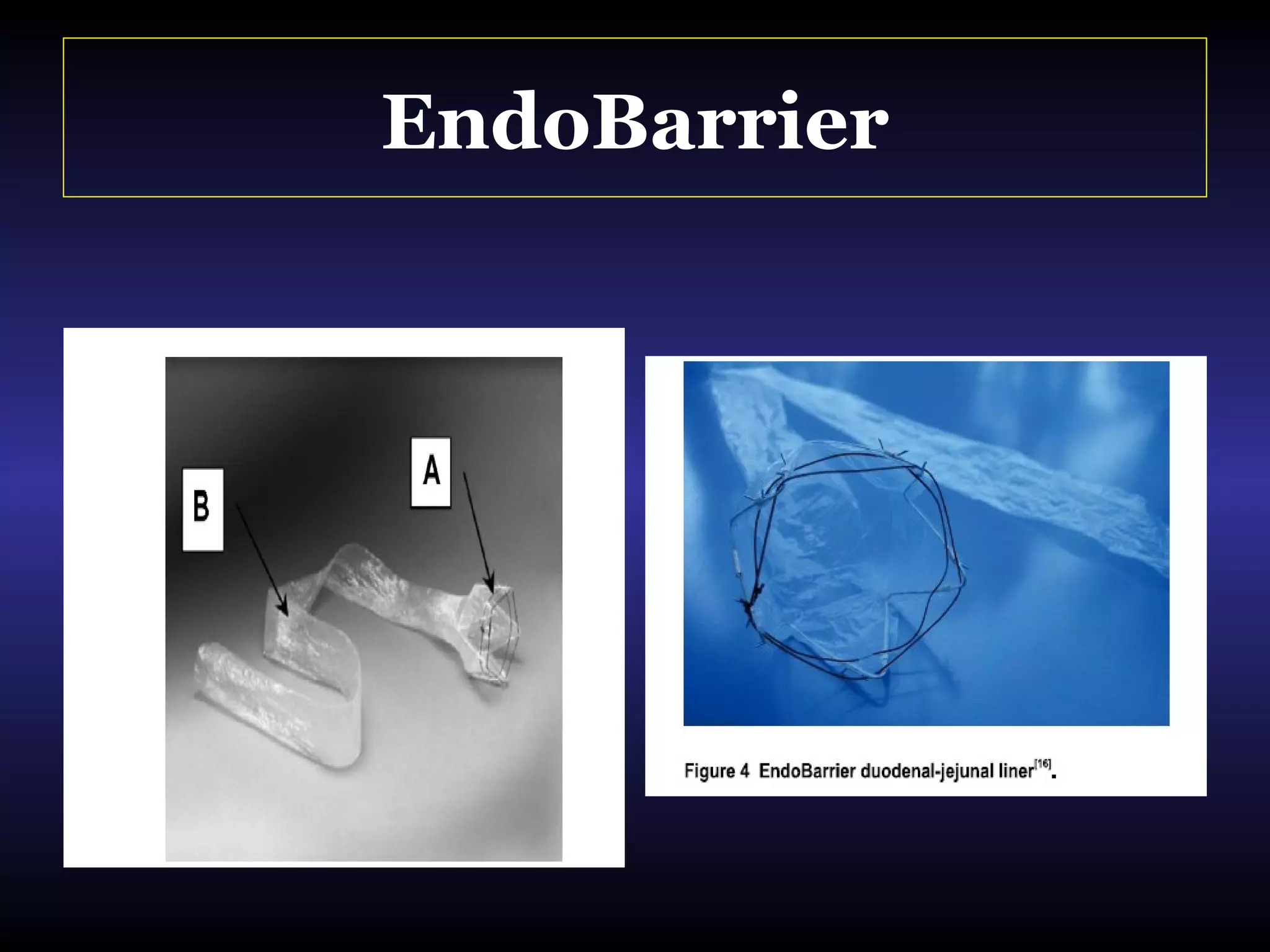 Endoscopic Management Of Obesity-Endobariatrics | PPT
