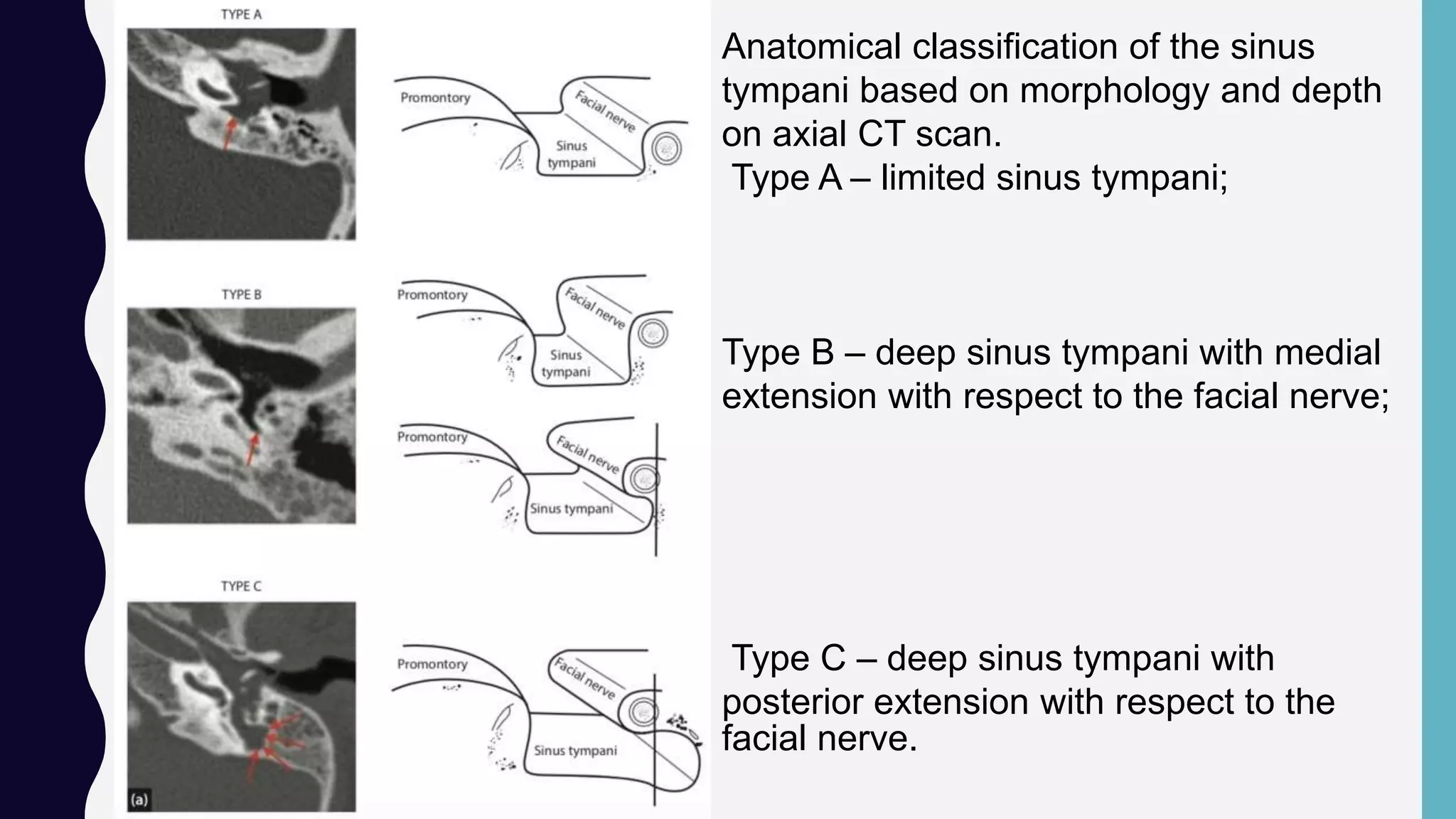 Endoscopic middle ear surgery | PPTX