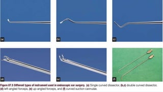 Endoscopic middle ear surgery | PPTX