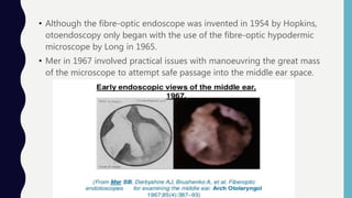 Endoscopic middle ear surgery | PPTX