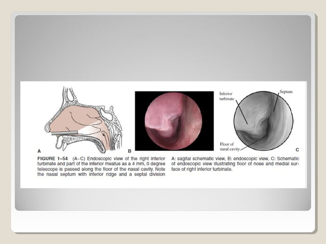 Endoscopic nasal anatomy | PPT | Ear, Nose and Throat Conditions ...