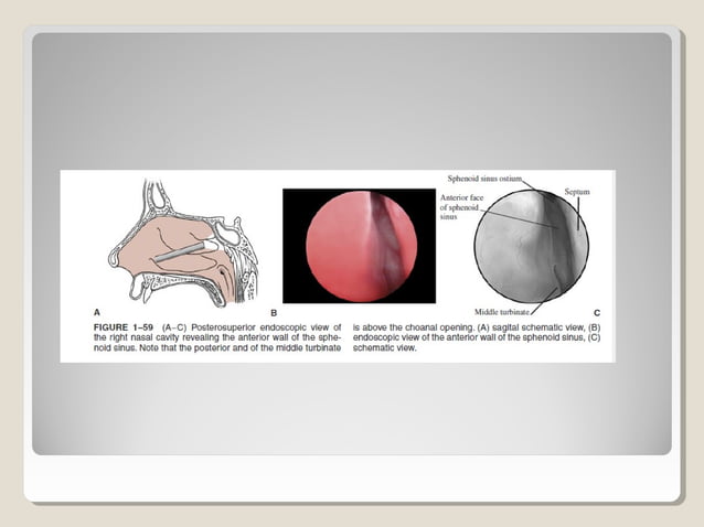 Endoscopic nasal anatomy | PPT | Ear, Nose and Throat Conditions ...