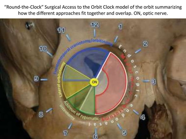 Endoscopic orbital surgery | PPTX | Eye and Vision Conditions ...