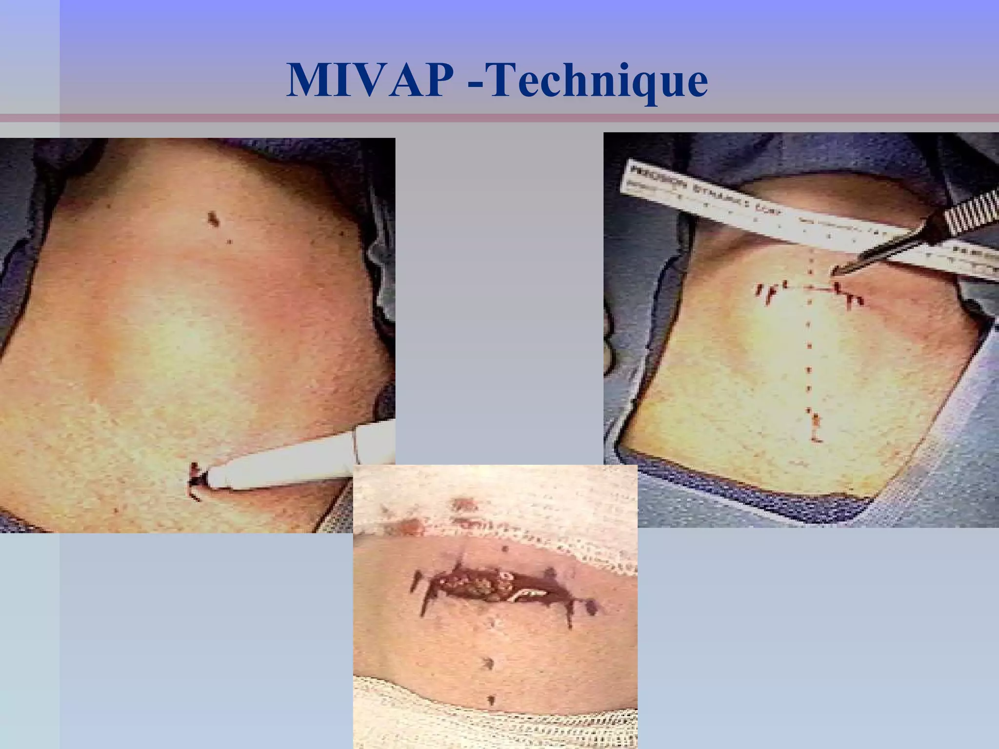 Endoscopic Parathyroid Surgery | PPT
