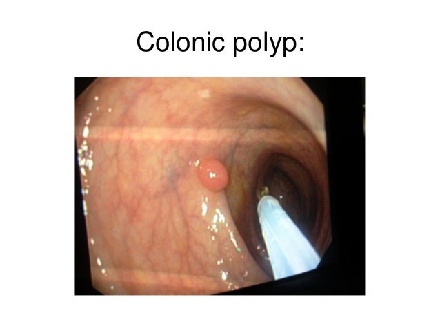 Endoscopic pics jan 2013.