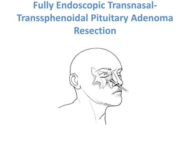 Endoscopic pituitary surgery | PPTX | Ear, Nose and Throat Conditions ...
