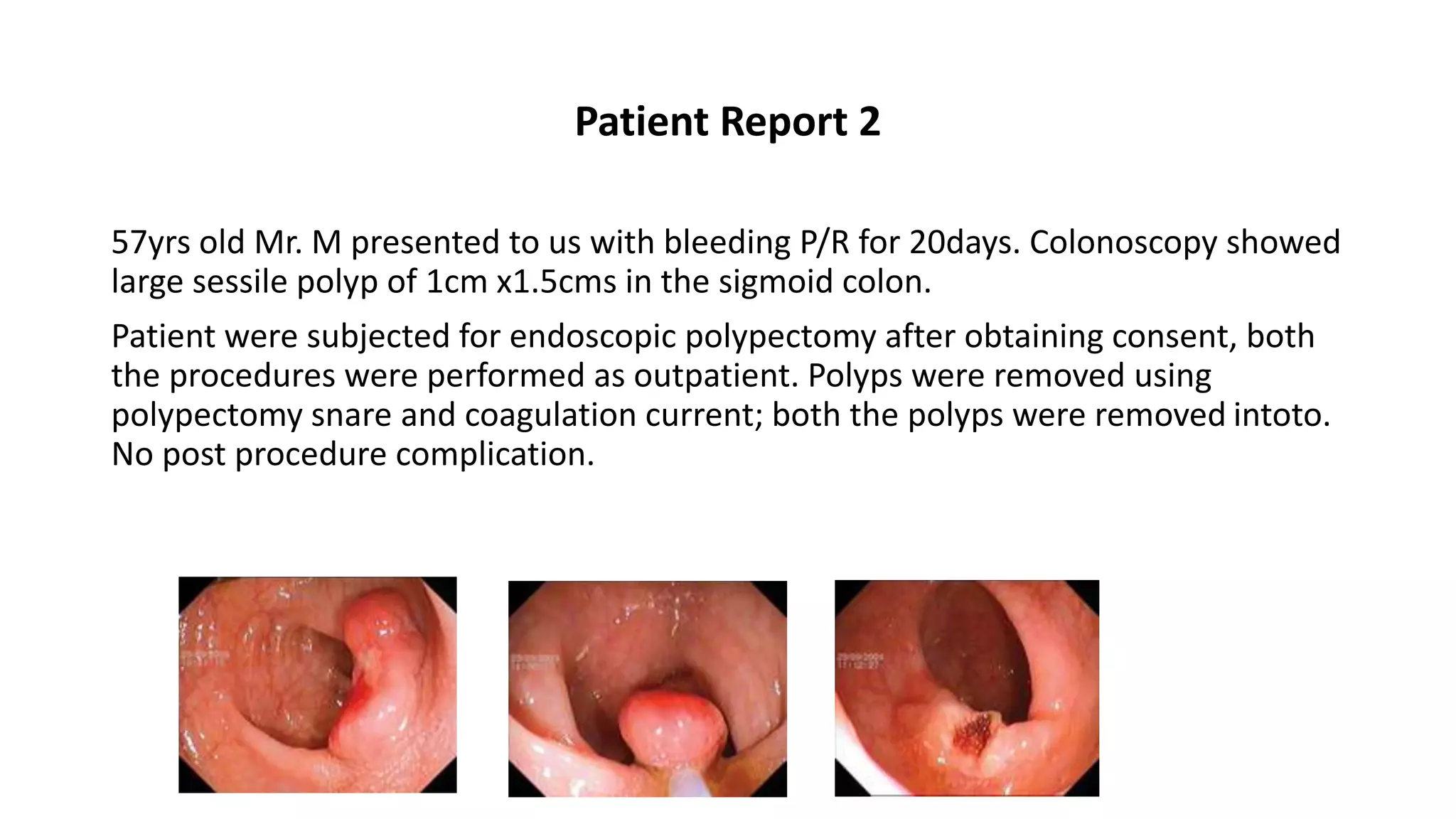 Endoscopic removal of colonic polyps | PPTX