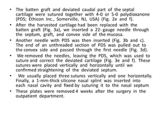 Endoscopic single handed septoplasty with batten graft for caudal | PPTX