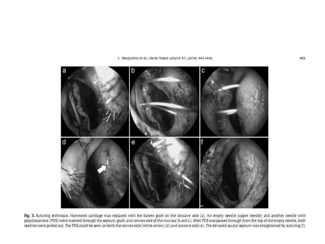 Endoscopic single handed septoplasty with batten graft for caudal | PPT