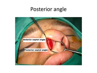 Endoscopic single handed septoplasty with batten graft for caudal | PPTX