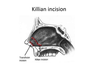 Endoscopic single handed septoplasty with batten graft for caudal | PPTX