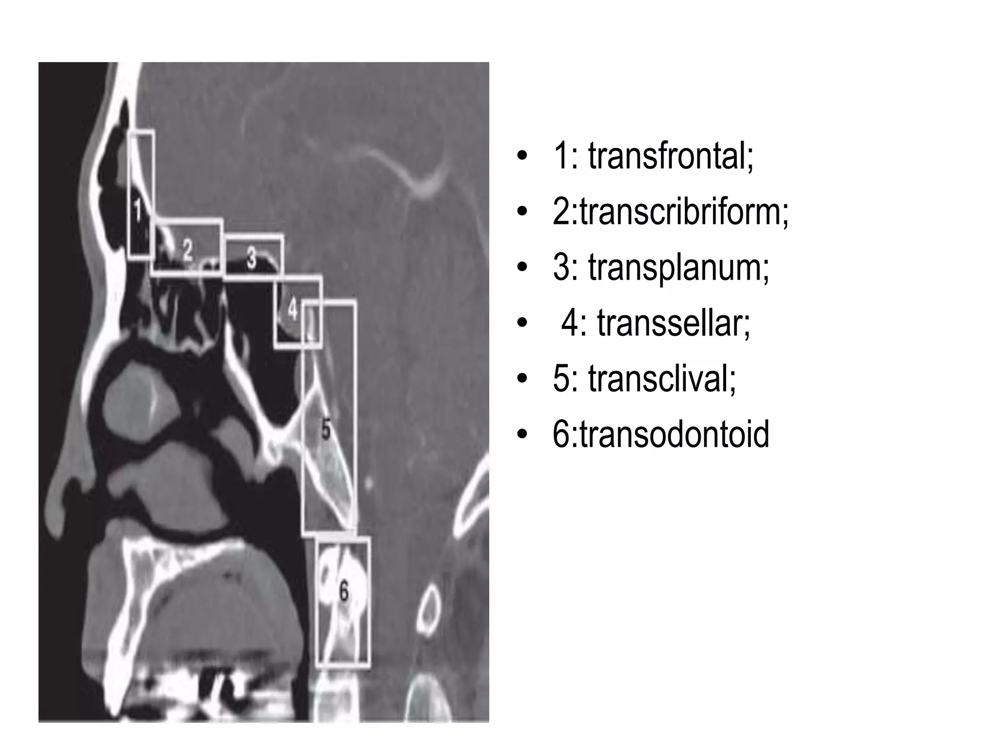 Endoscopic skull base surgeries | PPTX