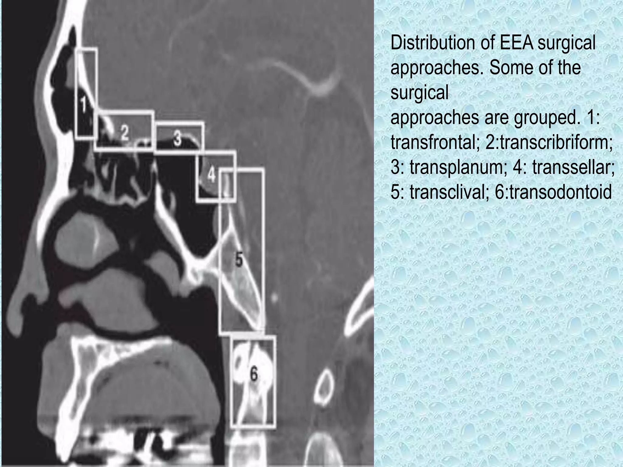 Endoscopic skull base surgery level iii | PPTX