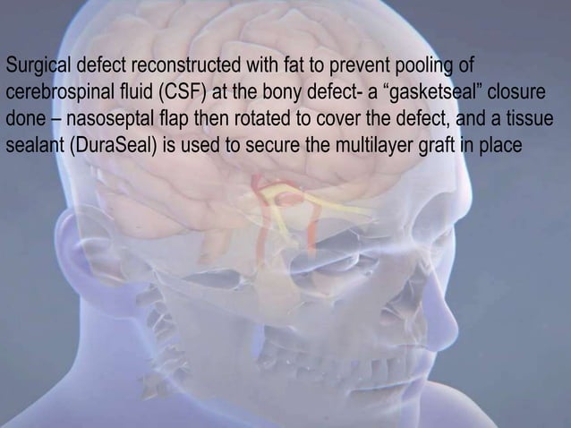 Endoscopic skull base surgery level iii | PPT