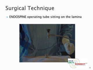 Endoscopic spinal surgery | PPTX
