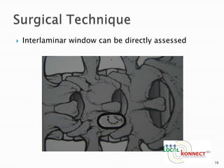 Endoscopic spinal surgery | PPTX