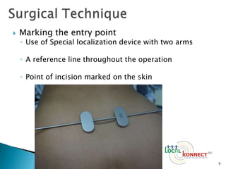 Endoscopic spinal surgery | PPTX