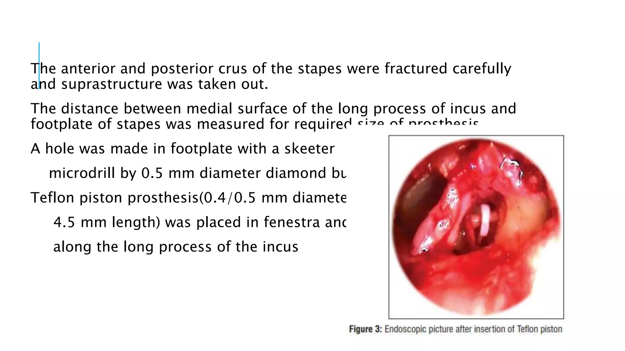 ENDOSCOPIC TRANSCANAL STAPEDOTOMY.pptx
