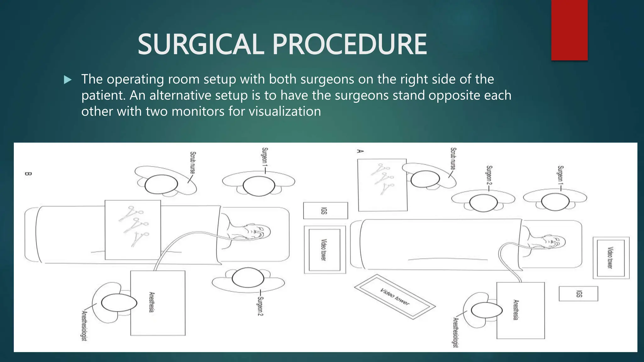 Endoscopic Transnasal transsphenoid pituitary Surgery (Erbil).pptx