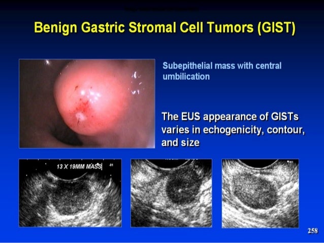 Endoscopic ultrasonographi