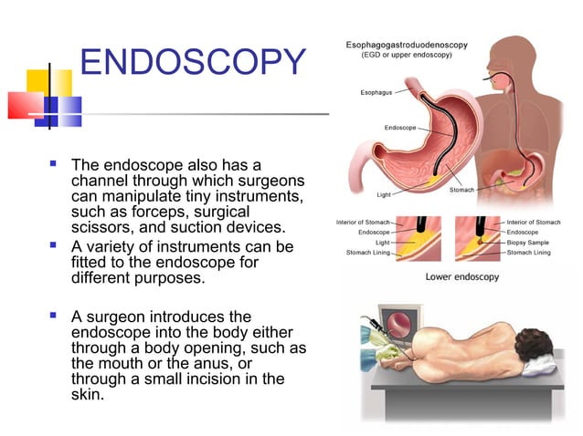 Endoscopy | PPT | Digestive Disorders | Diseases and Conditions