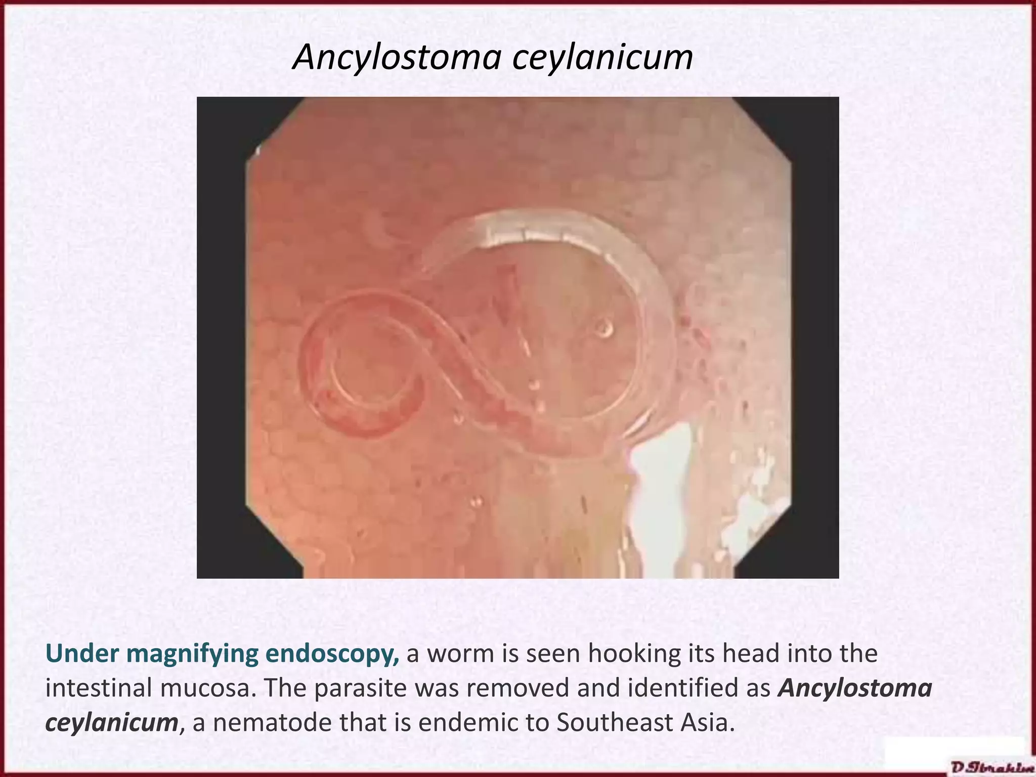 Endoscopy helminth.pptx