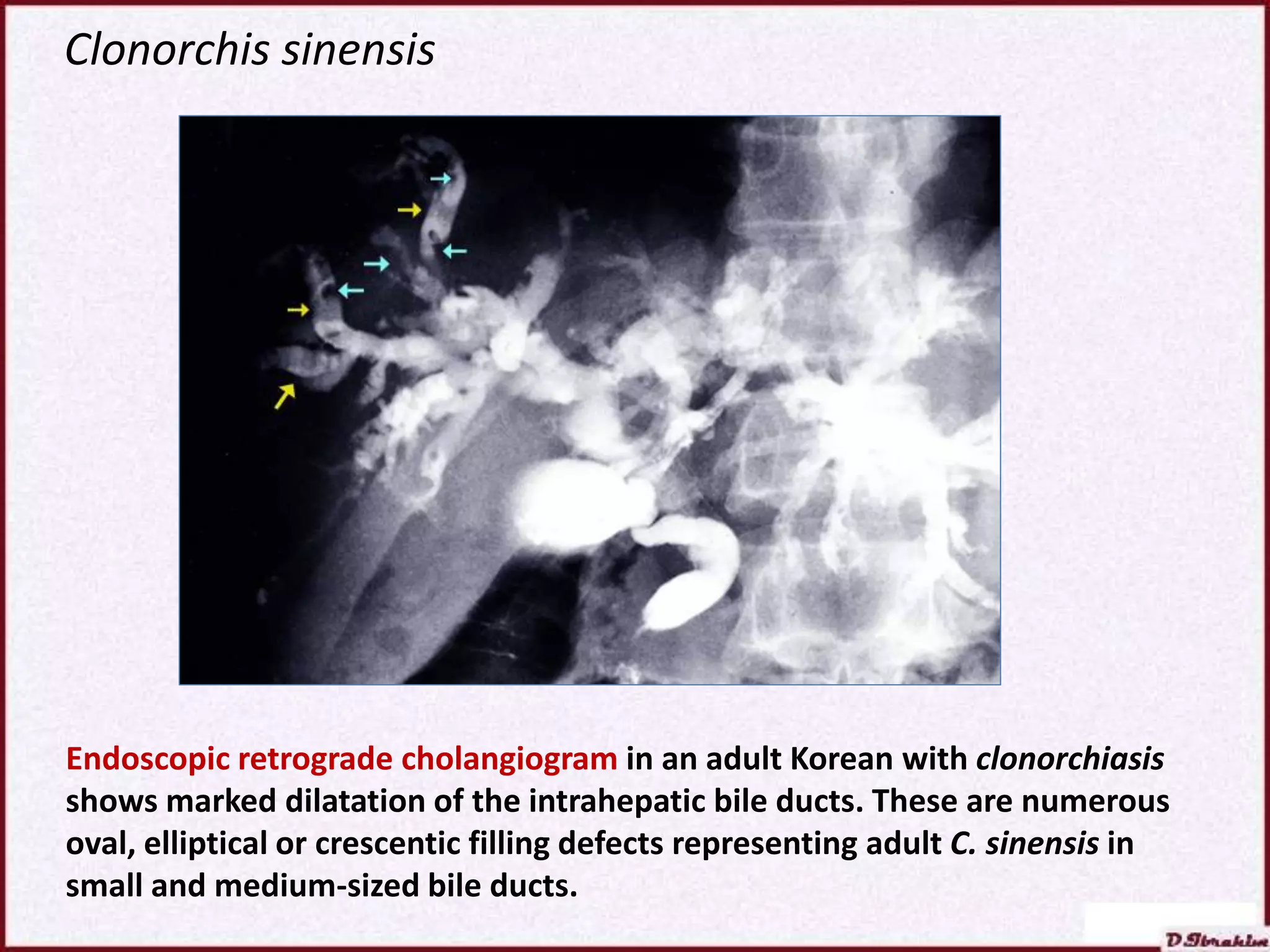 Endoscopy helminth.pptx