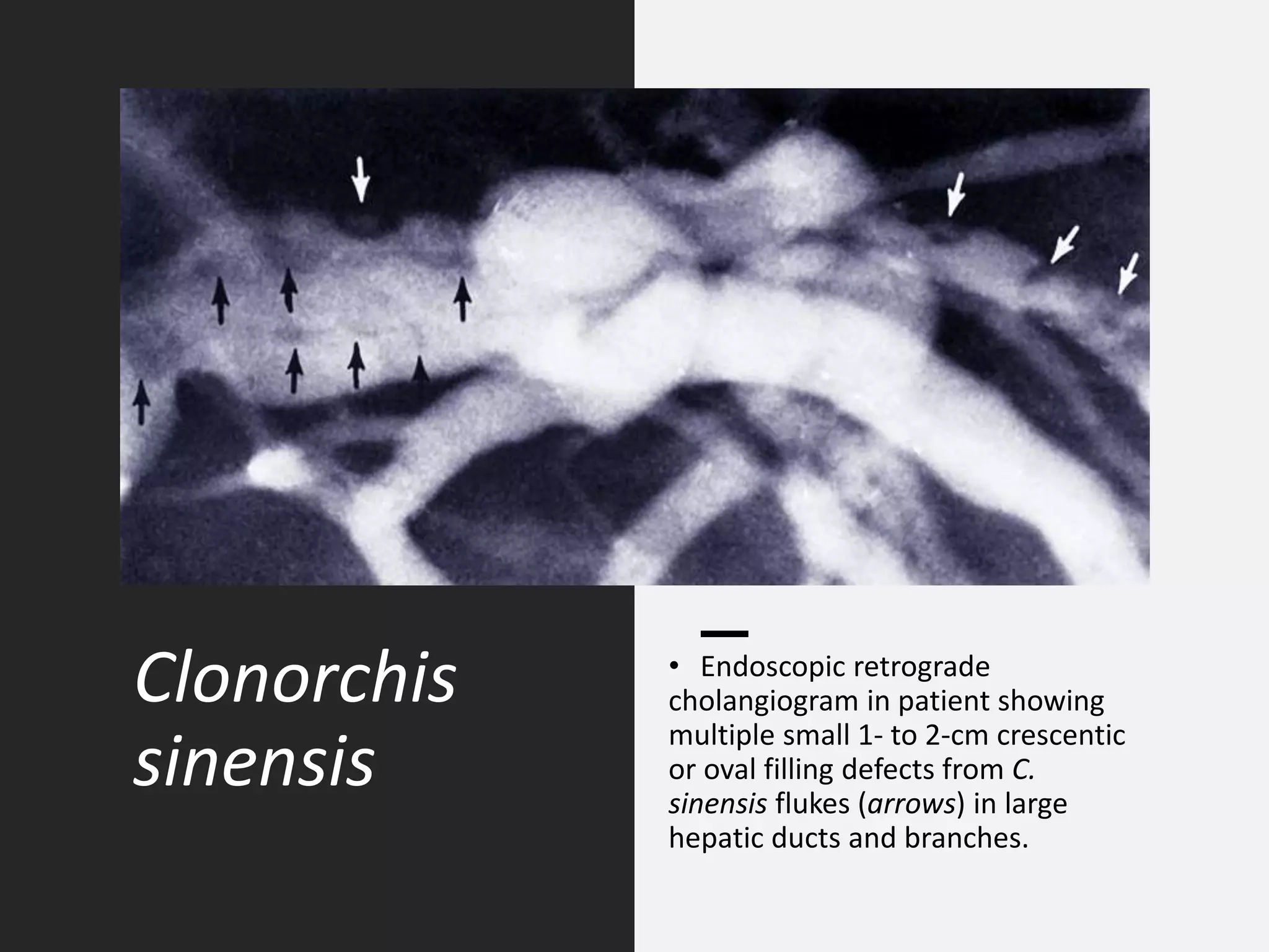 Endoscopy helminth.pptx
