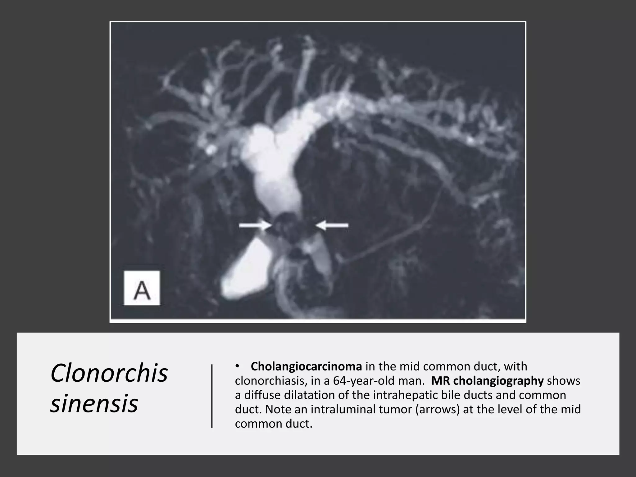 Endoscopy helminth.pptx