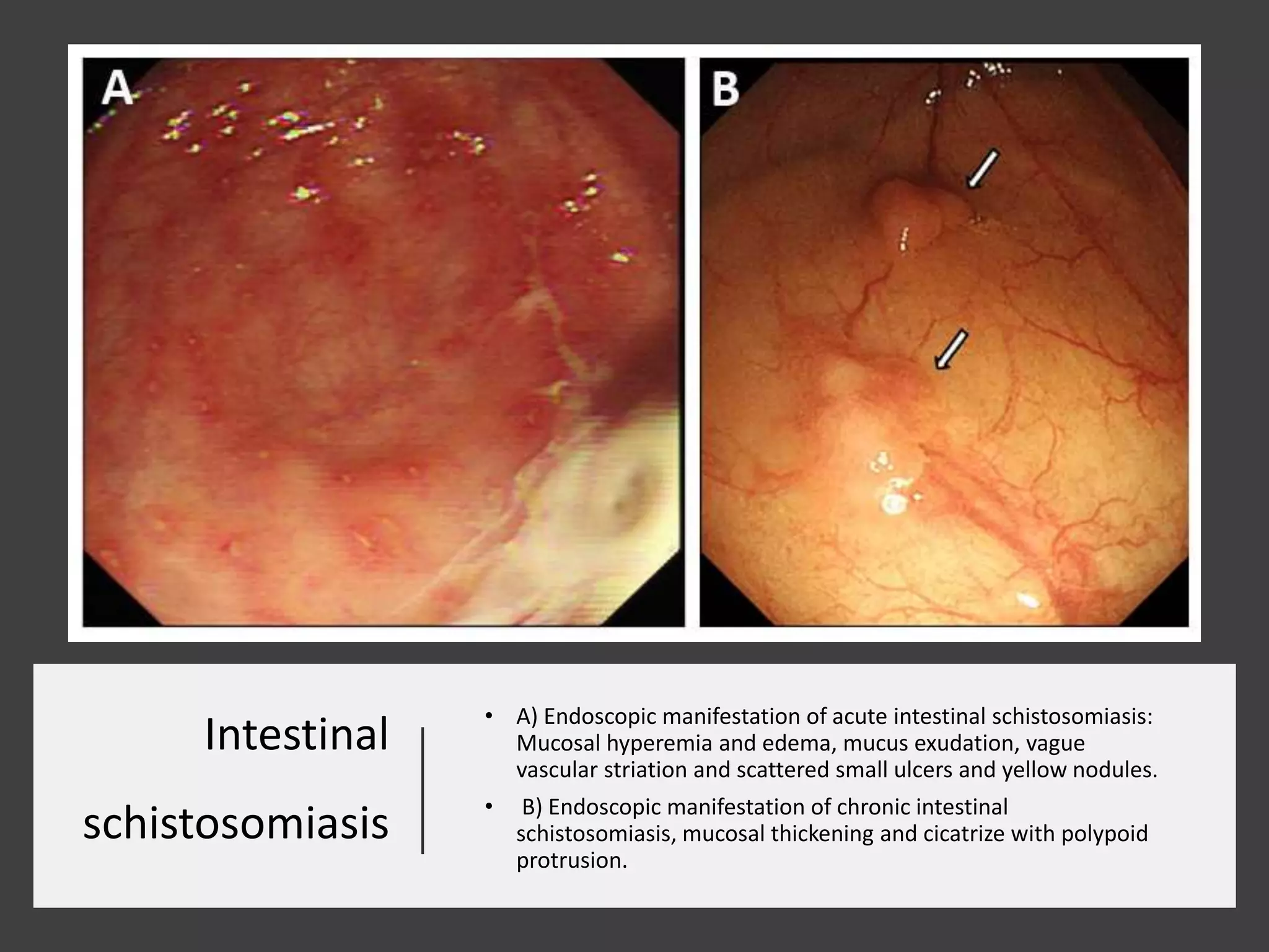 Endoscopy helminth.pptx