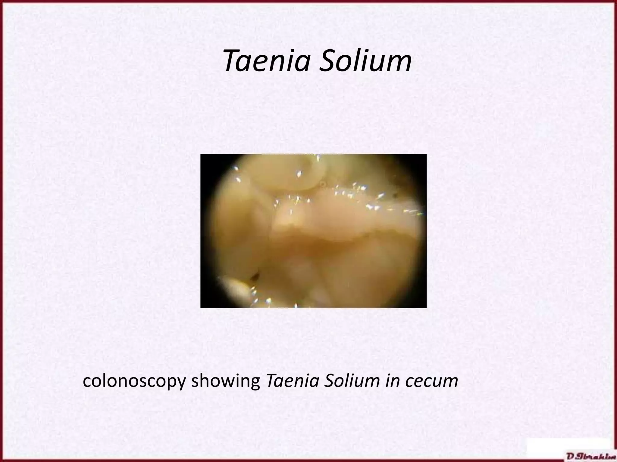 Endoscopy helminth.pptx