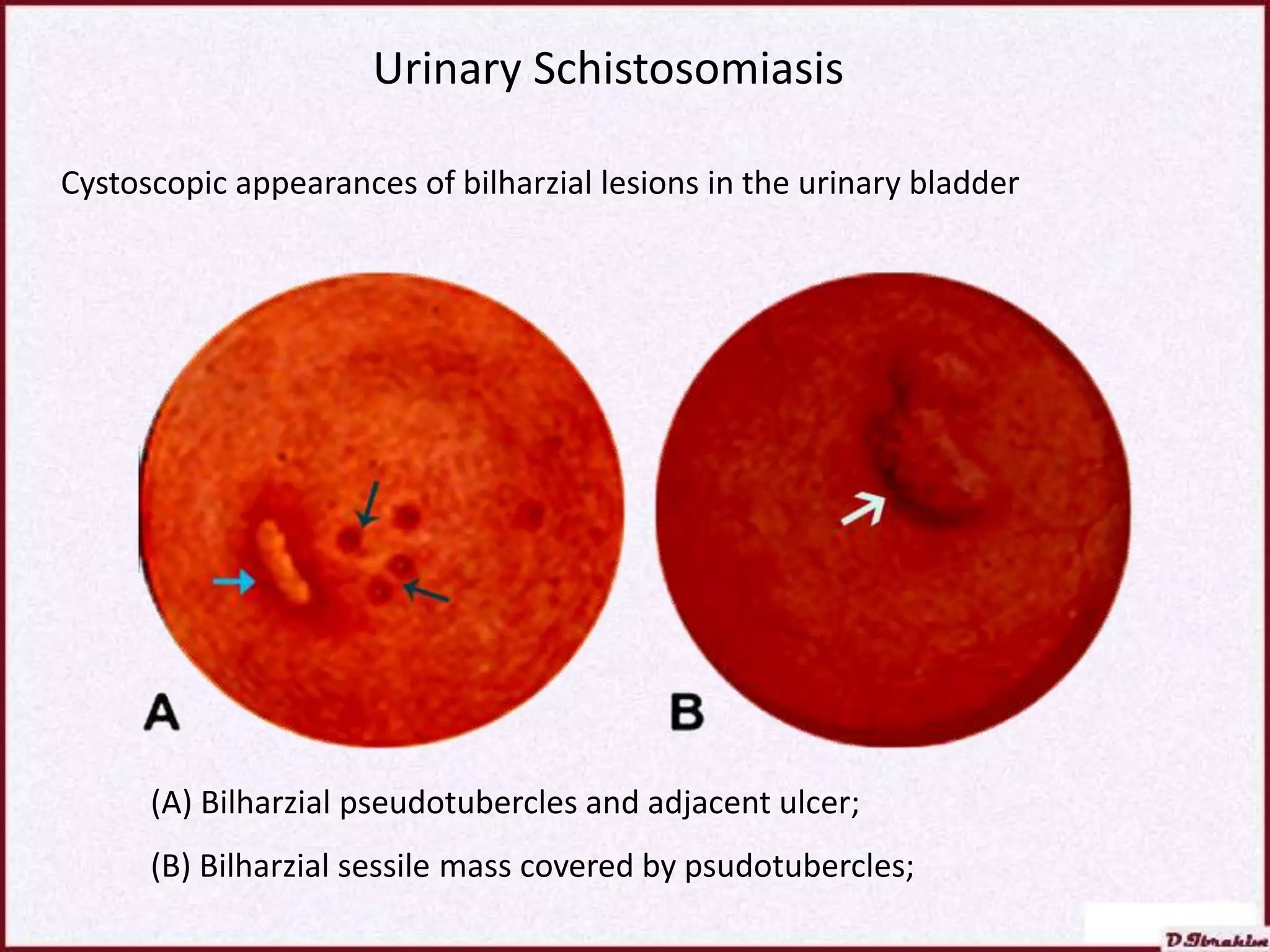 Endoscopy helminth.pptx