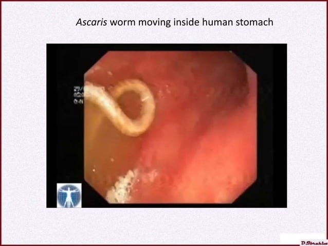 Endoscopy helminth.pptx