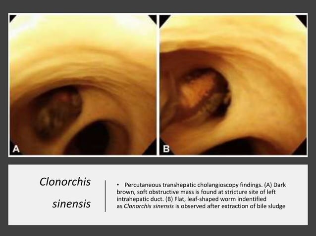 Endoscopy helminth.pptx | Free Download