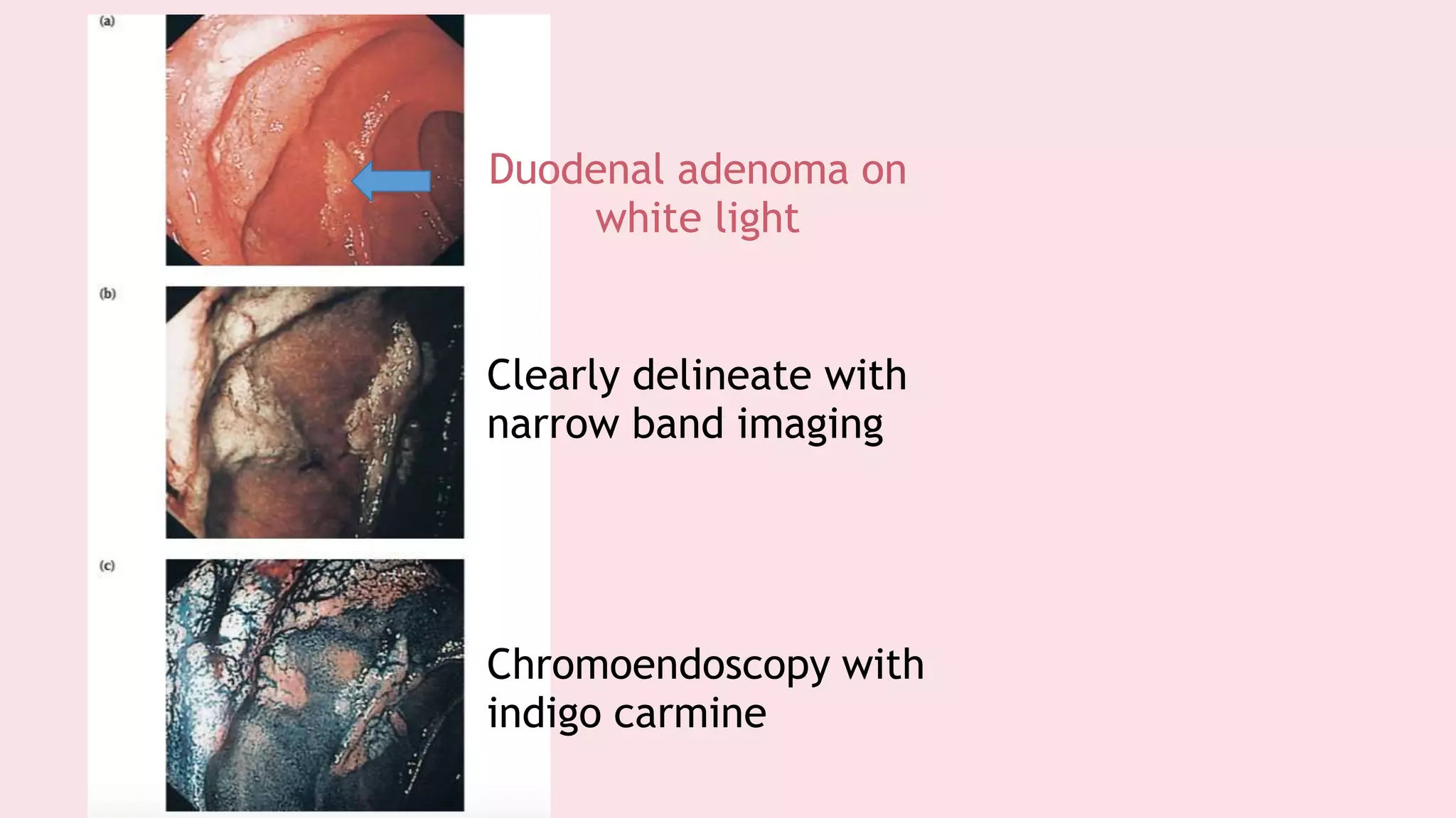 Endoscopy in surgery | PPTX